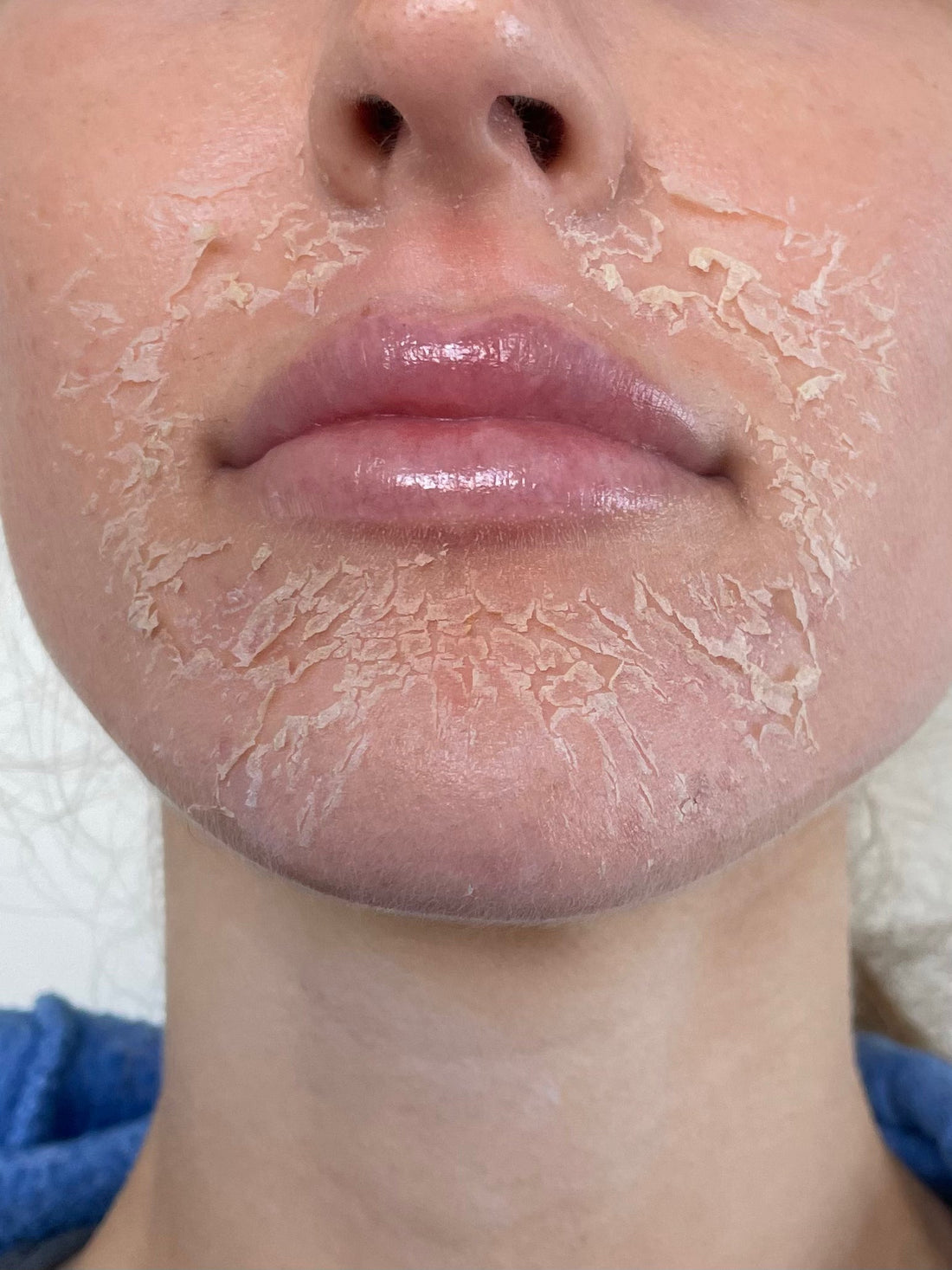 Reveal Radiant, Youthful Skin with The Perfect Derma Peel – Ballanced ...